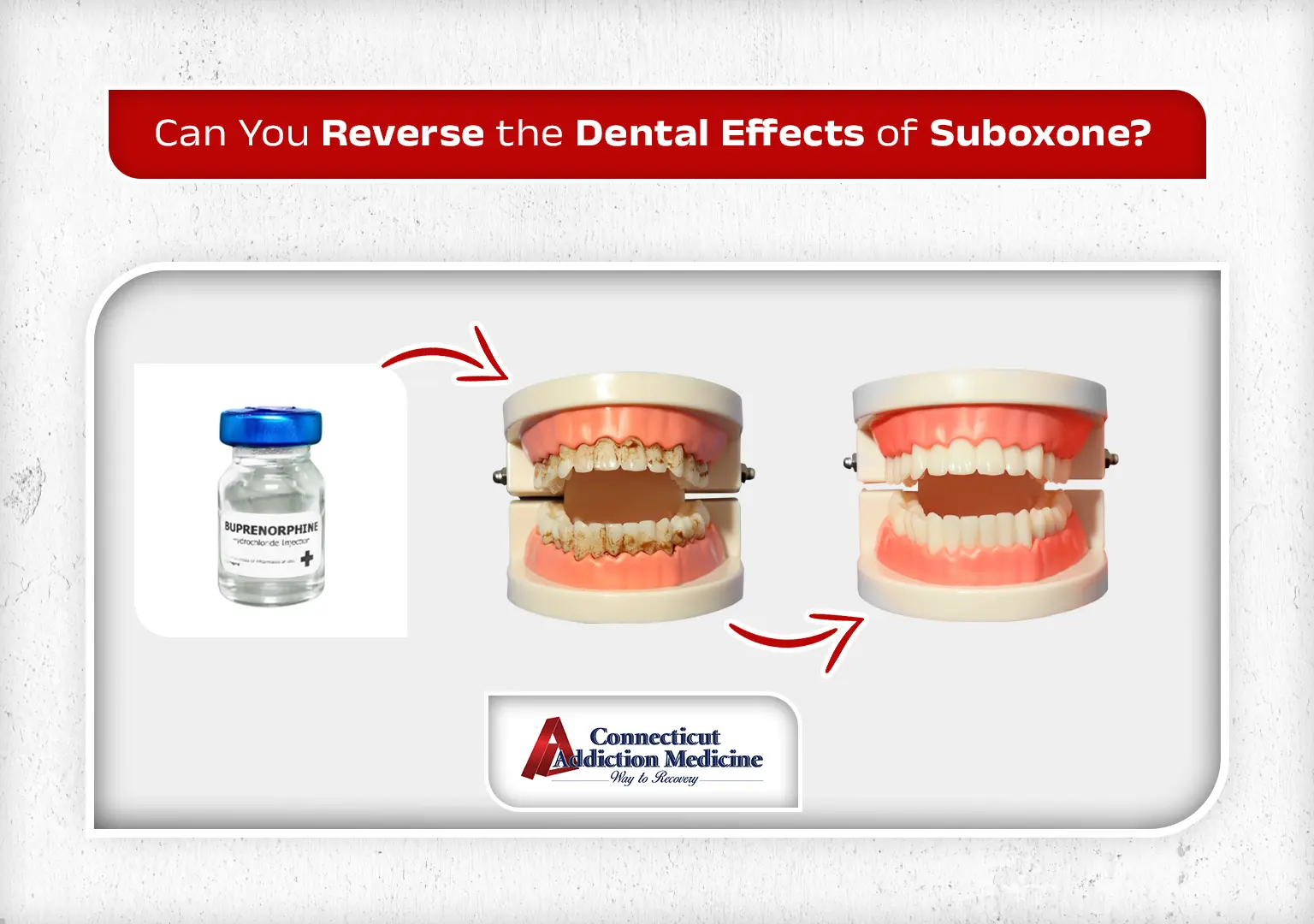 Can You Reverse the Dental Effects of Suboxone?